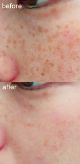 freckles treatment at our dermatologists office in Cleveland treating ...